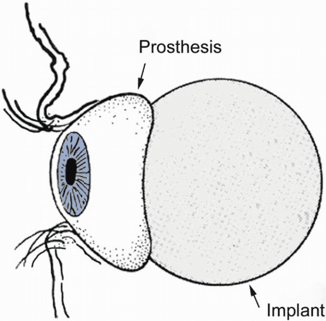 Temporary Prosthesis After Surgery Can Help Ease the Psychological ...
